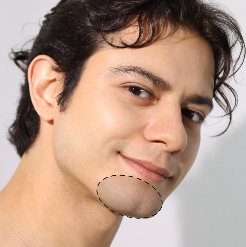 Barbilla – Depiliclinic